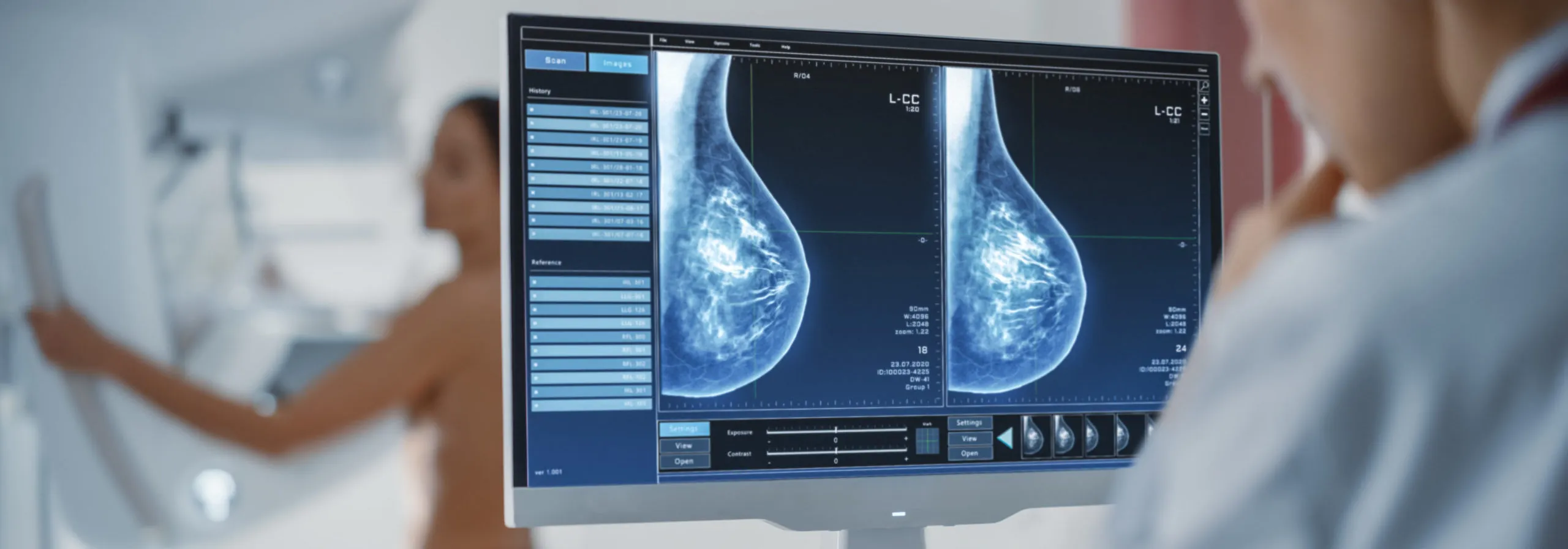 AI in Mammography: MASAI Study Shows 28% Better Cancer Detection