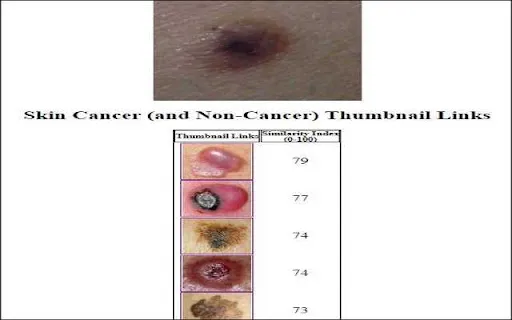 Skin Cancer Image Search: Compare Your Moles | Creati.ai